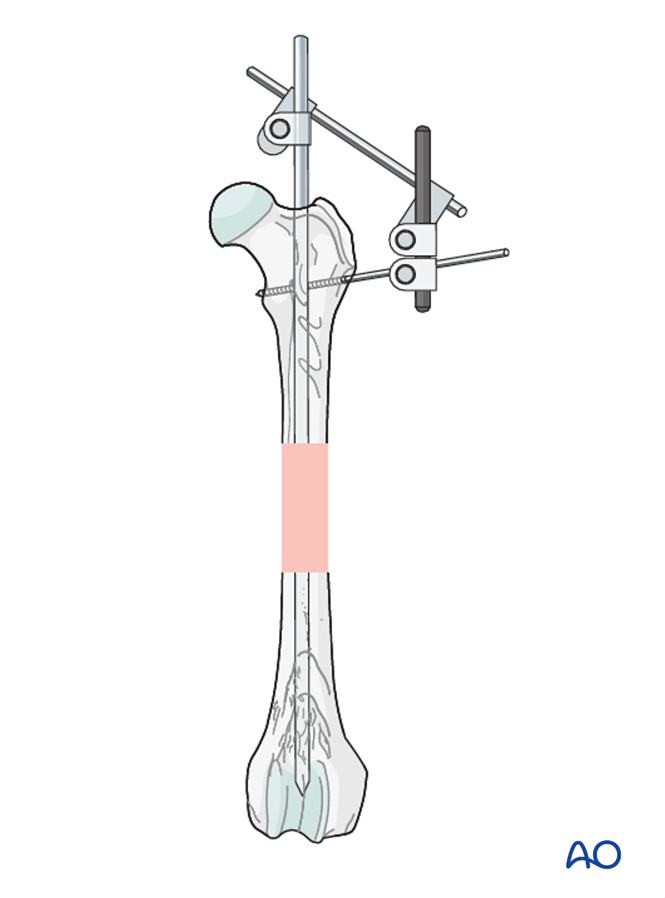Tie-in technique for Diaphyseal fractures with greater than 1 ...