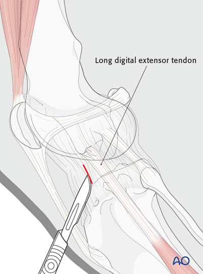 Percutaneous approach to the dog distal femur
