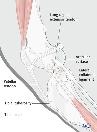 Tibial crest osteotomy to the dog distal femur