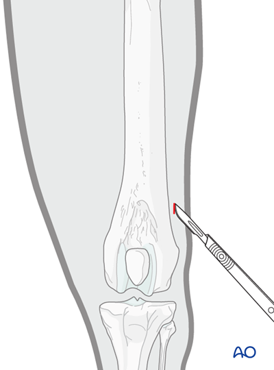 Safe zones for external skeletal fixator in the dog distal femur