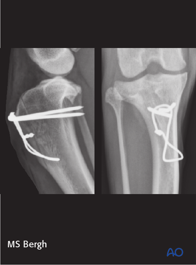 Tibial crest osteotomy to the dog distal femur
