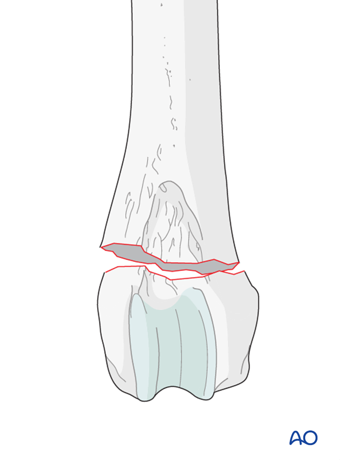 Simple extraarticular fracture