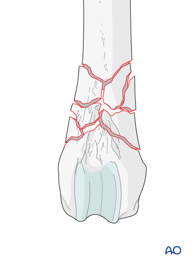 Multifragmentary extraarticular fracture
