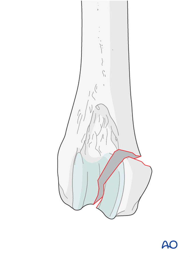 Partial articular lateral sagittal fracture