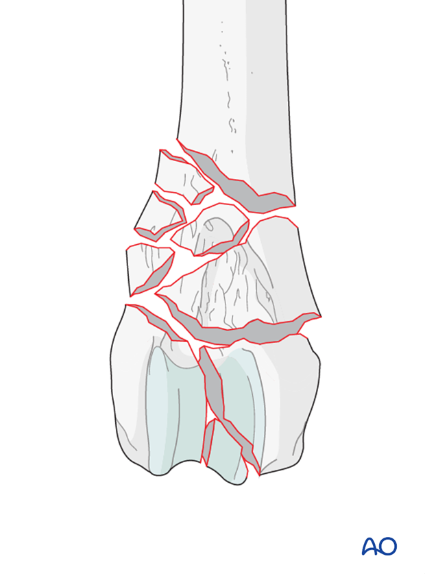 Complete articular multifragmentary fracture