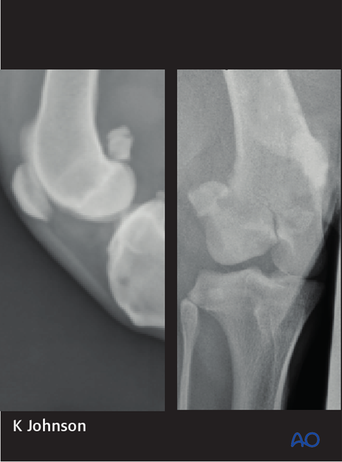 Partial articular lateral sagittal fracture