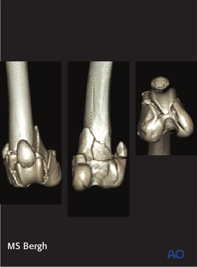 Complete articular multifragmentary fracture