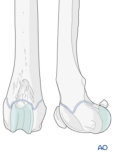 Closed reduction for Extra-articular fracture, simple