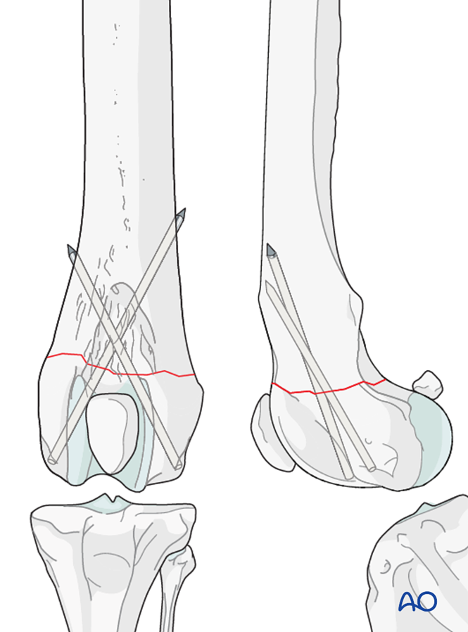Cross pinning for Extra-articular fracture, simple