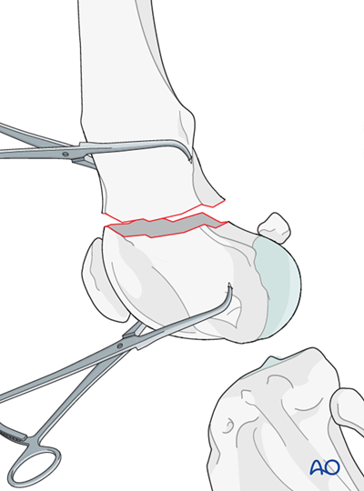 Cross pinning for Extra-articular fracture, simple