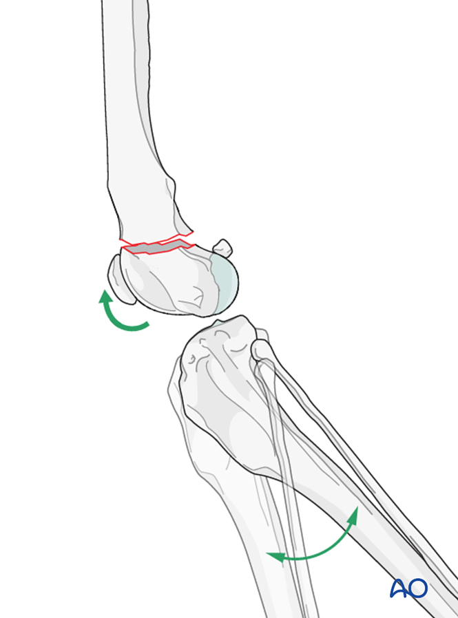 Cross pinning for Extra-articular fracture, simple