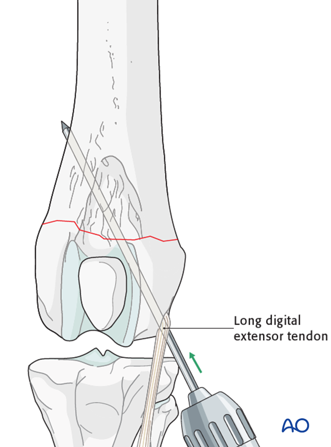 Cross pinning for Extra-articular fracture, simple
