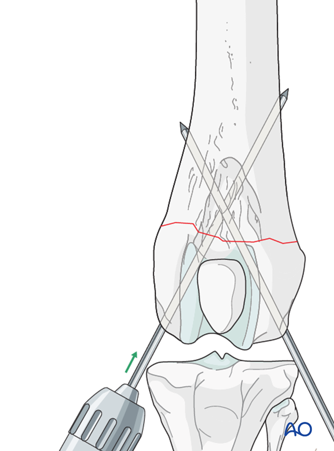 Cross pinning for Extra-articular fracture, simple