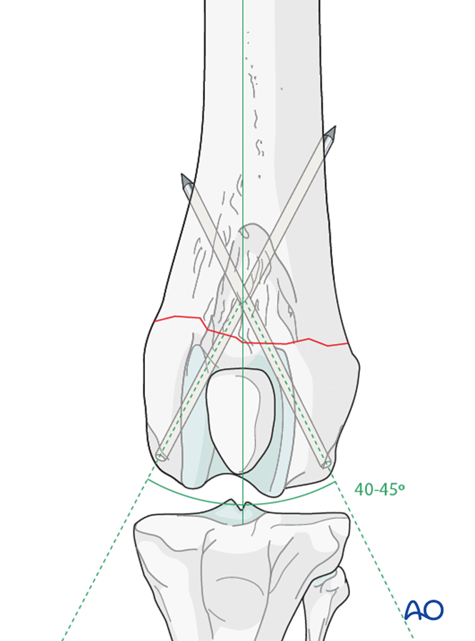 Cross pinning for Extra-articular fracture, simple