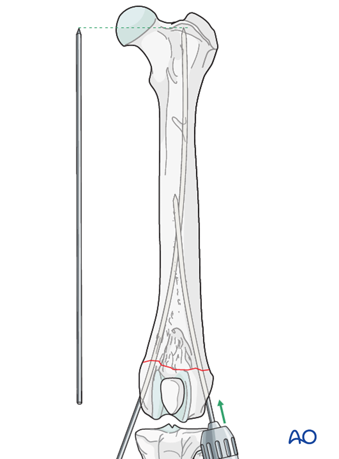Cross pinning for Extra-articular fracture, simple