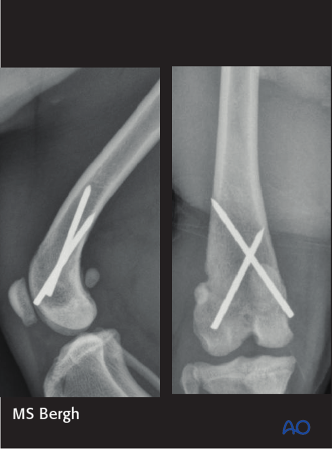 Cross pinning for Extra-articular fracture, simple