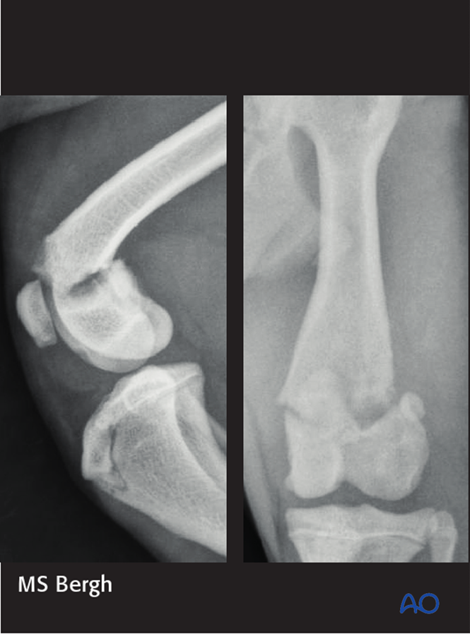 Cross pinning for Extra-articular fracture, simple