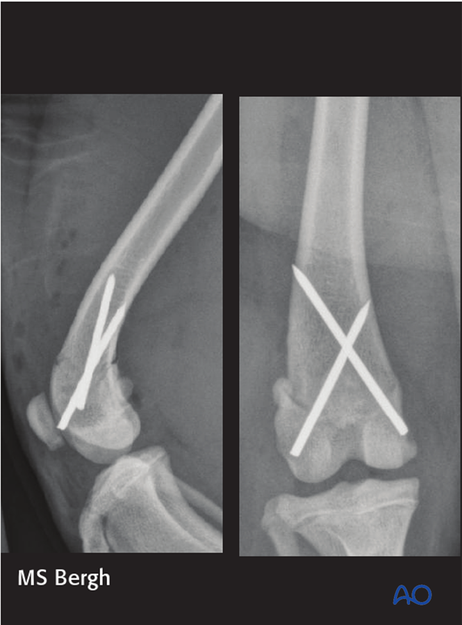 Cross pinning for Extra-articular fracture, simple