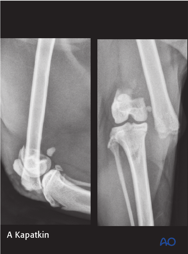 Cross pinning for Extra-articular fracture, simple