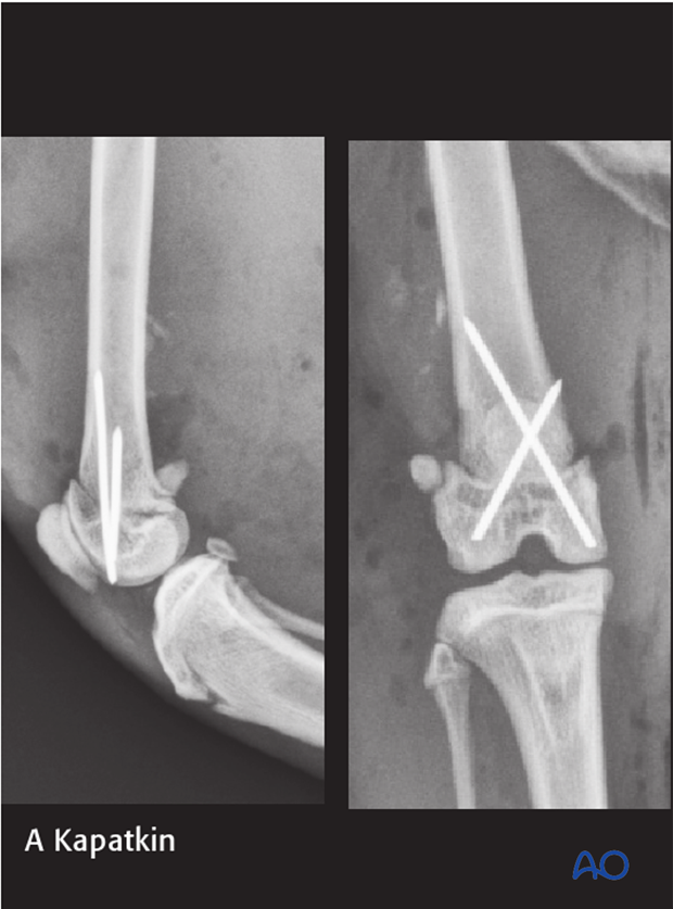 Cross pinning for Extra-articular fracture, simple
