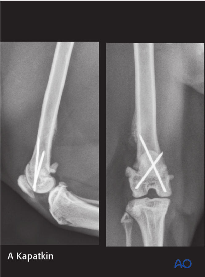 Cross pinning for Extra-articular fracture, simple
