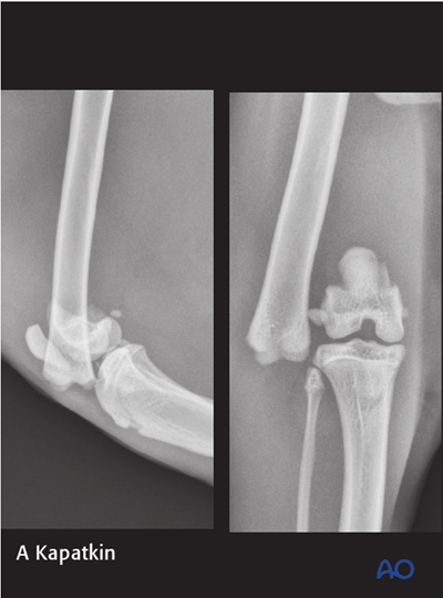 Cross pinning for Extra-articular fracture, simple