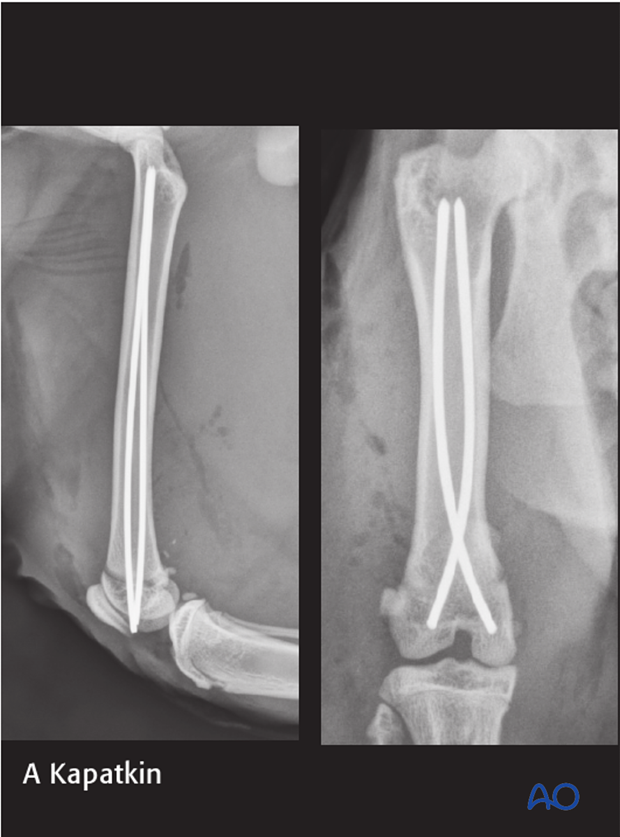 Cross pinning for Extra-articular fracture, simple