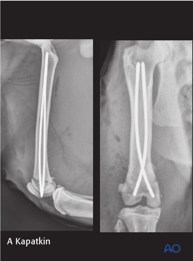 Cross pinning for Extra-articular fracture, simple