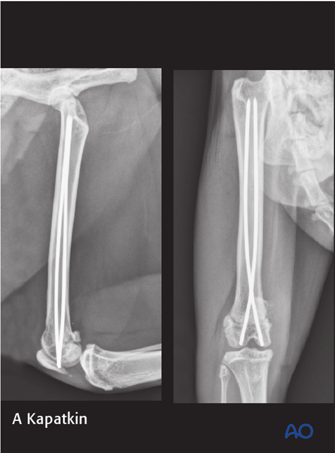 Cross pinning for Extra-articular fracture, simple