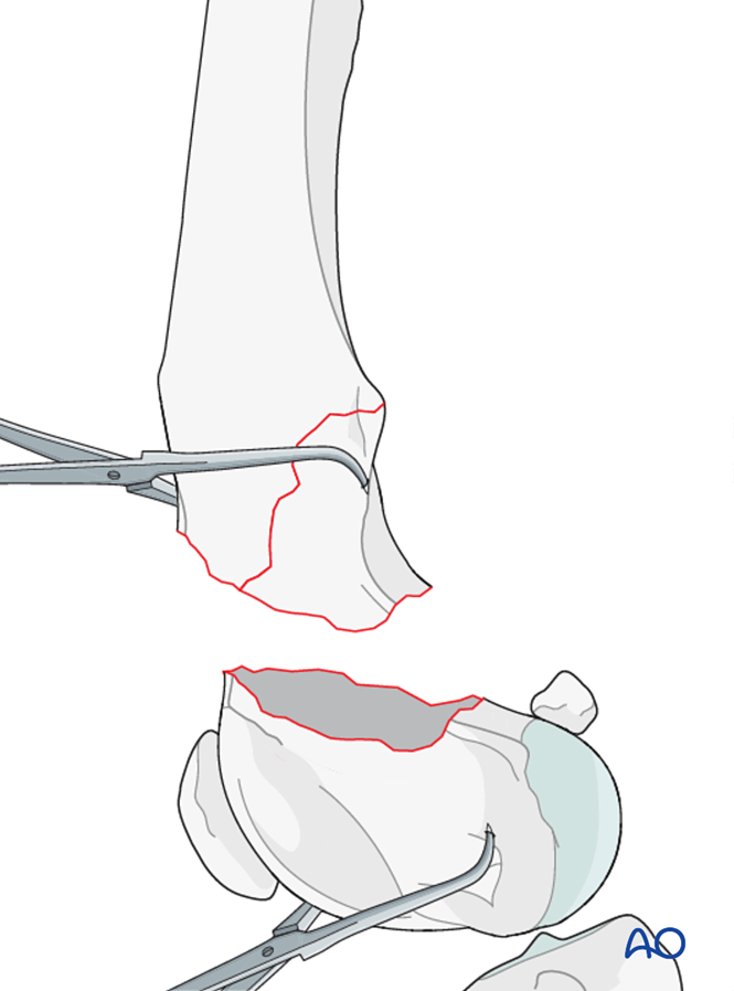 Cross pinning for Extra-articular fracture, wedge