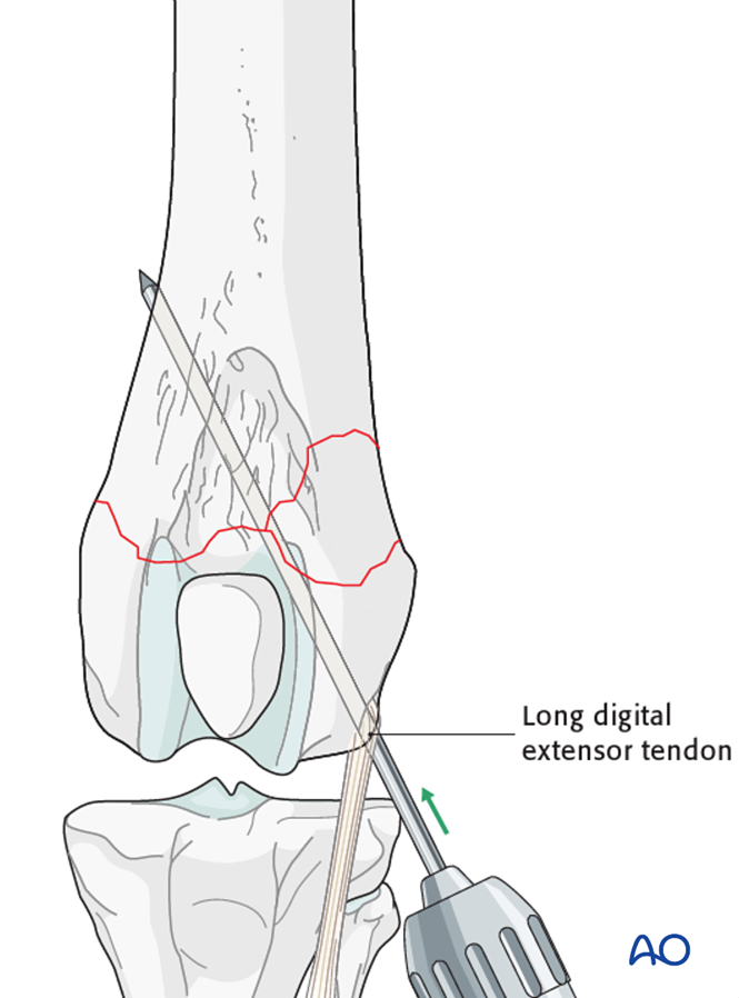 Cross pinning for Extra-articular fracture, wedge