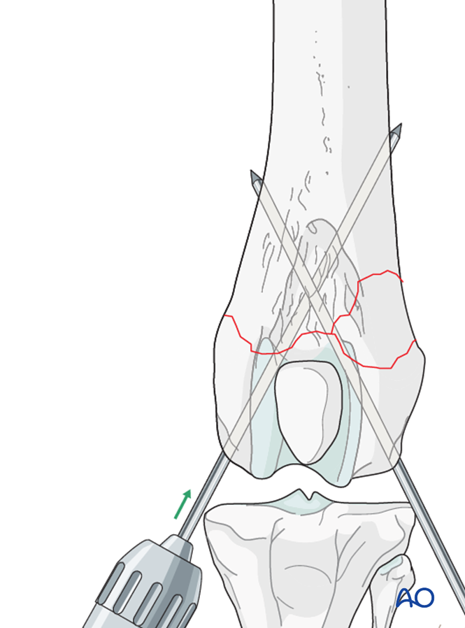 Cross pinning for Extra-articular fracture, wedge