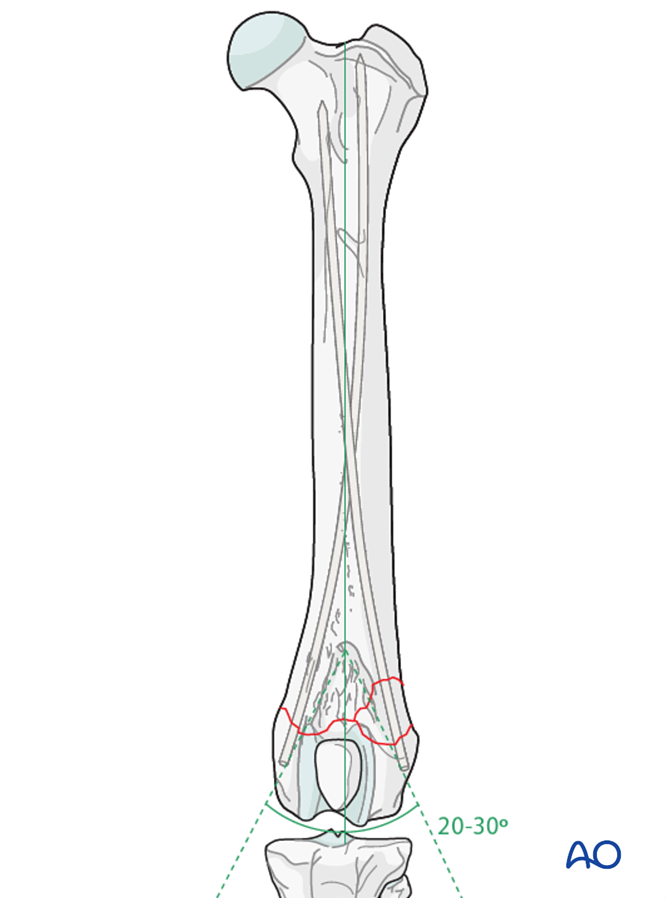 Cross pinning for Extra-articular fracture, wedge