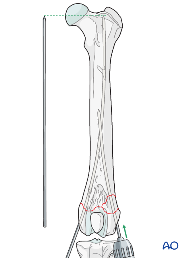 Cross pinning for Extra-articular fracture, wedge