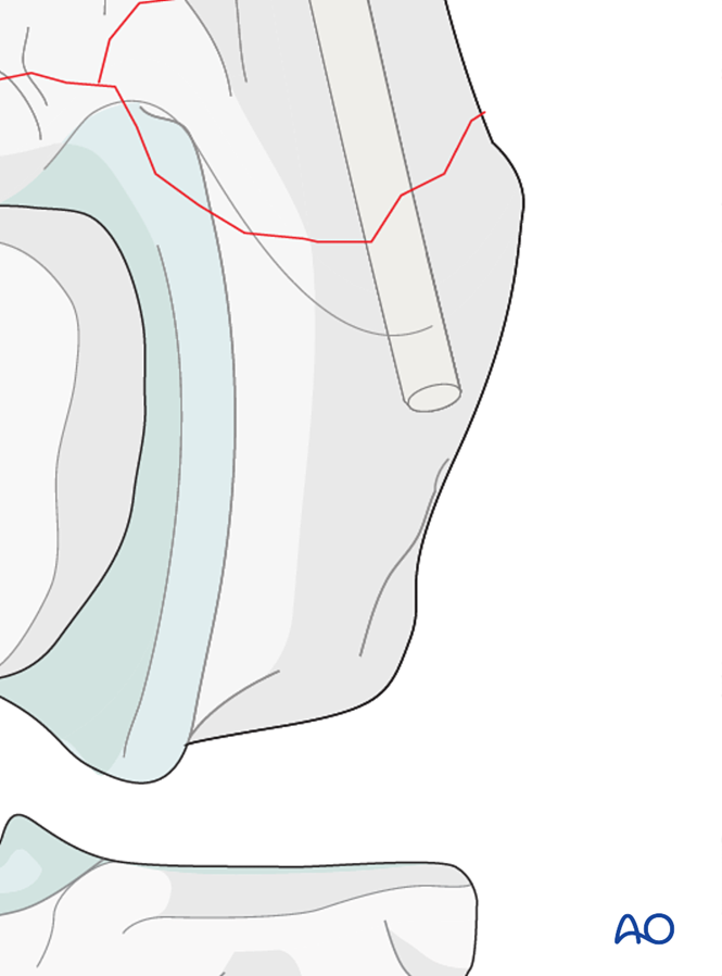 Cross pinning for Extra-articular fracture, wedge