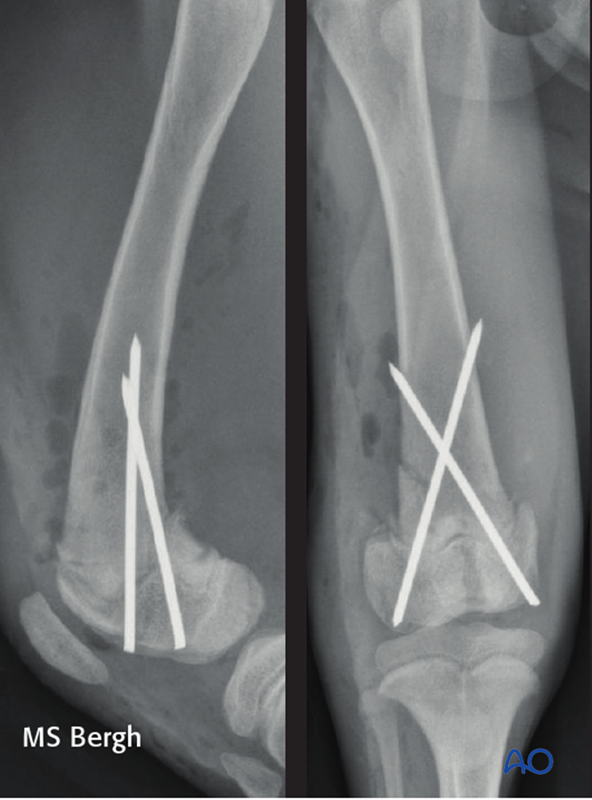 Cross pinning for Extra-articular fracture, wedge