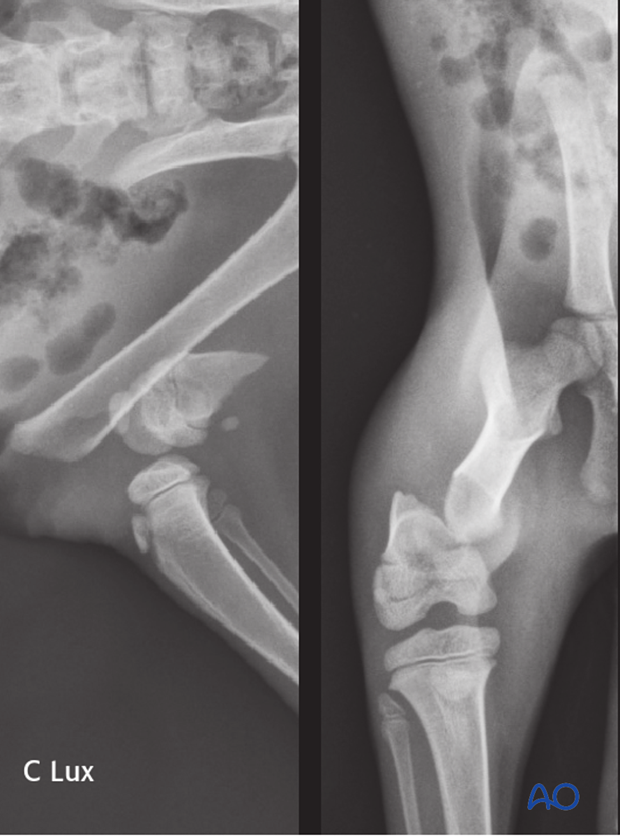 Cross pinning for Extra-articular fracture, wedge