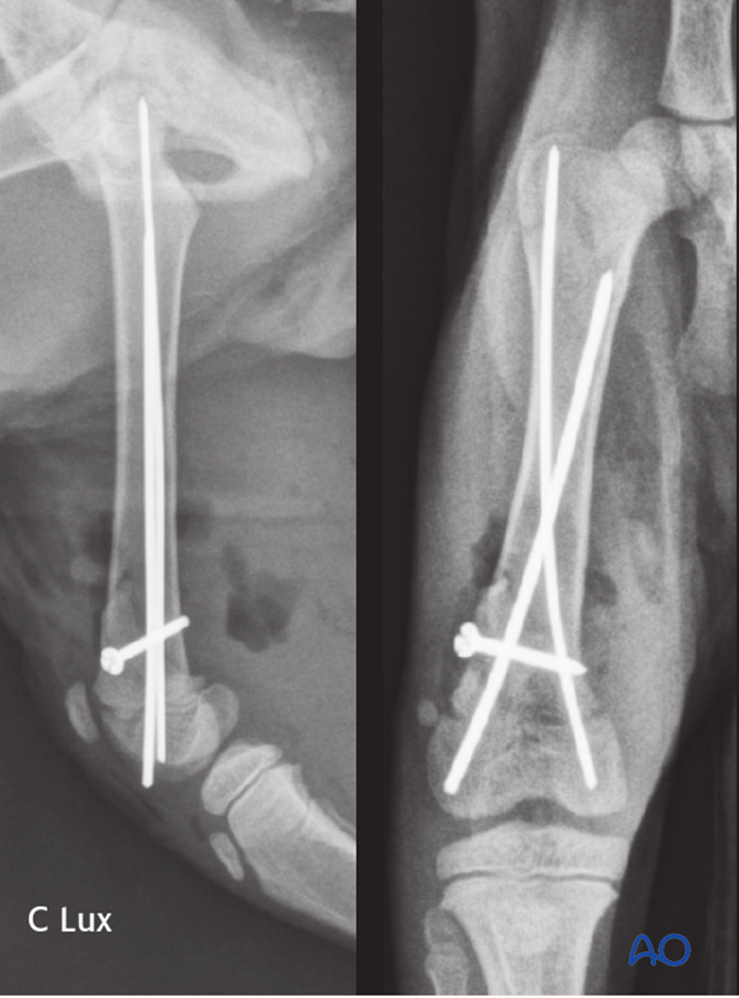 Cross pinning for Extra-articular fracture, wedge