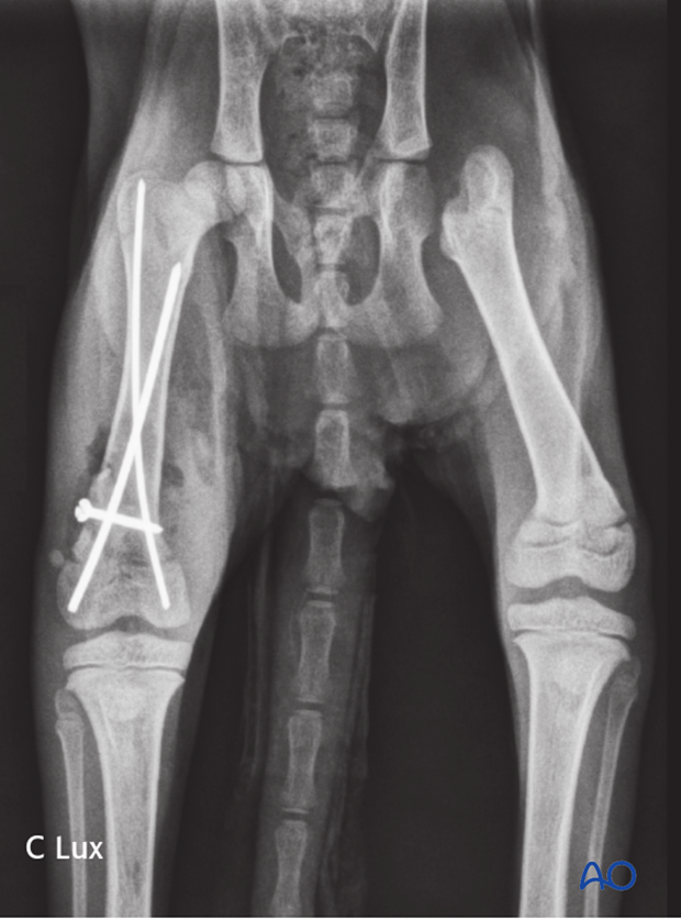 Cross pinning for Extra-articular fracture, wedge