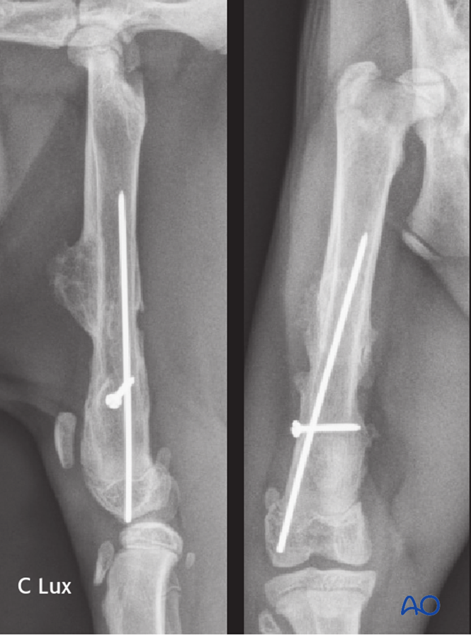 Cross pinning for Extra-articular fracture, wedge