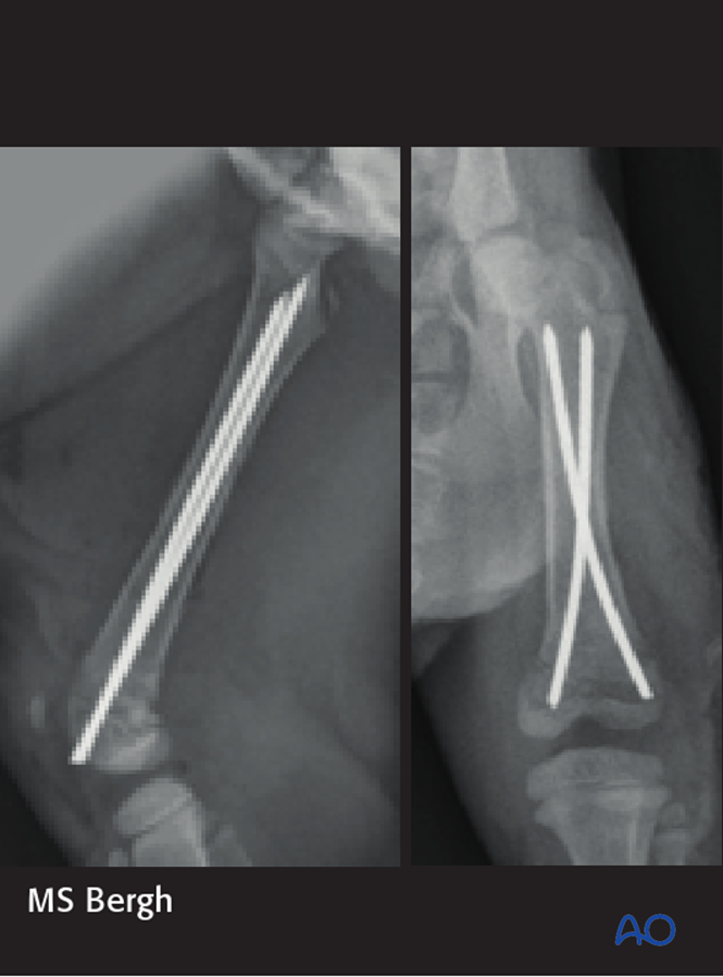 Cross pinning for Extra-articular fracture, wedge