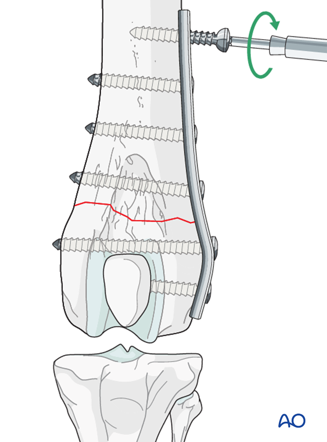 Plate fixation for Extra-articular fracture, simple