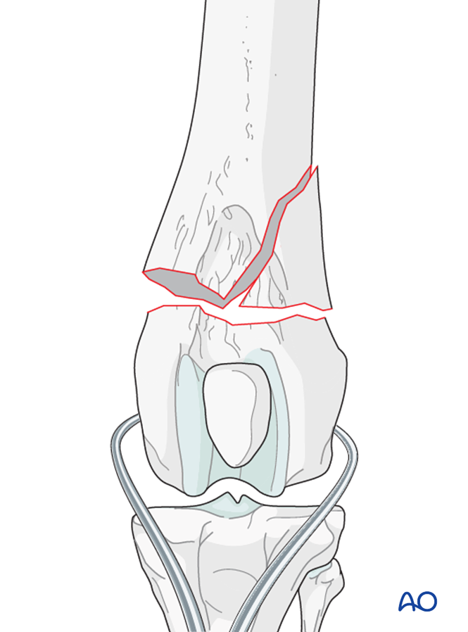 Neutralization plate for Extra-articular fracture, wedge