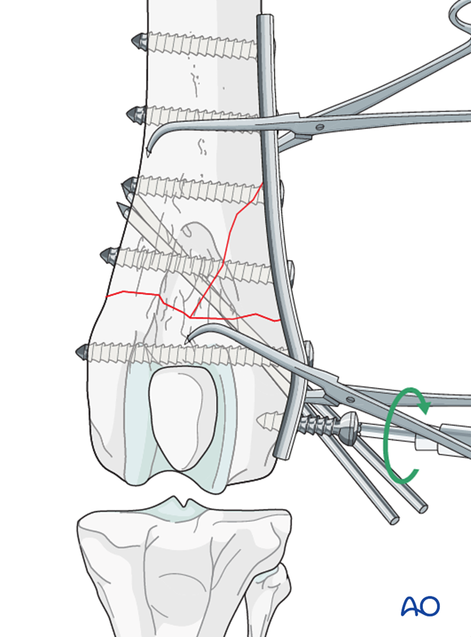 Neutralization plate for Extra-articular fracture, wedge