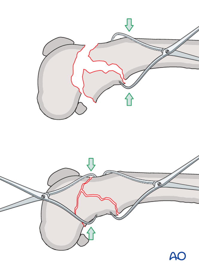 Lag screw and neutralization plate for Extra-articular fracture, complex