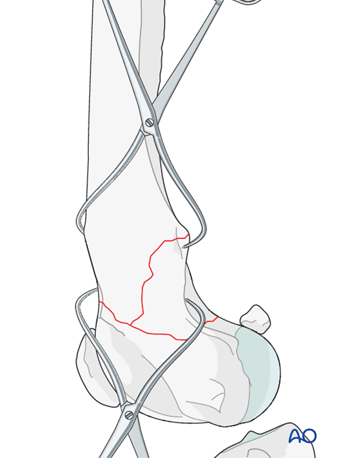 Lag screw and neutralization plate for Extra-articular fracture, complex