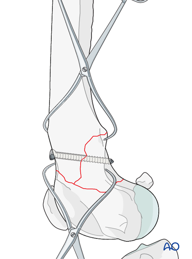 Lag screw and neutralization plate for Extra-articular fracture, complex