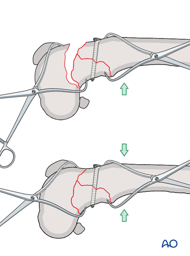 Lag screw and neutralization plate for Extra-articular fracture, complex