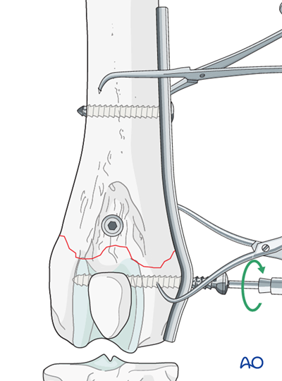 Lag screw and neutralization plate for Extra-articular fracture, complex