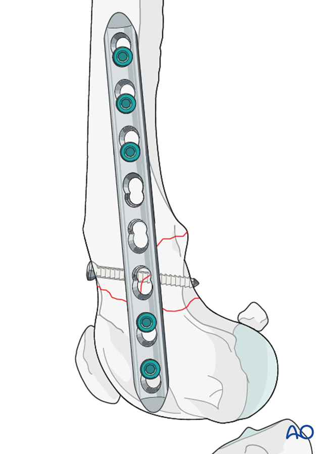 Lag screw and neutralization plate for Extra-articular fracture, complex